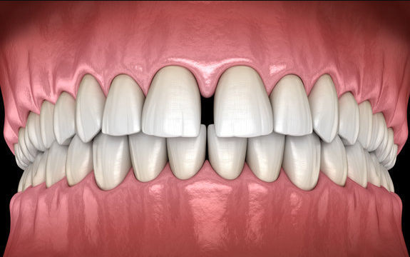 Invisalign treatment for gap teeth [Book your Free Consult!]