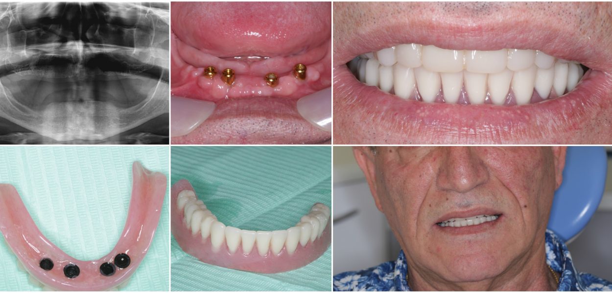 Smile Gallery | Implants - Ardent Smile clinic