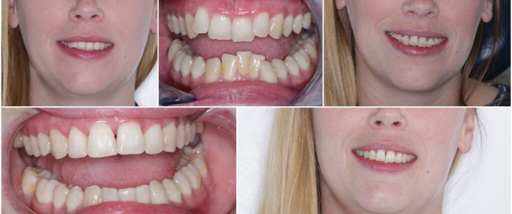 Smile Gallery | Six Month Smile - Ardent Smile clinic