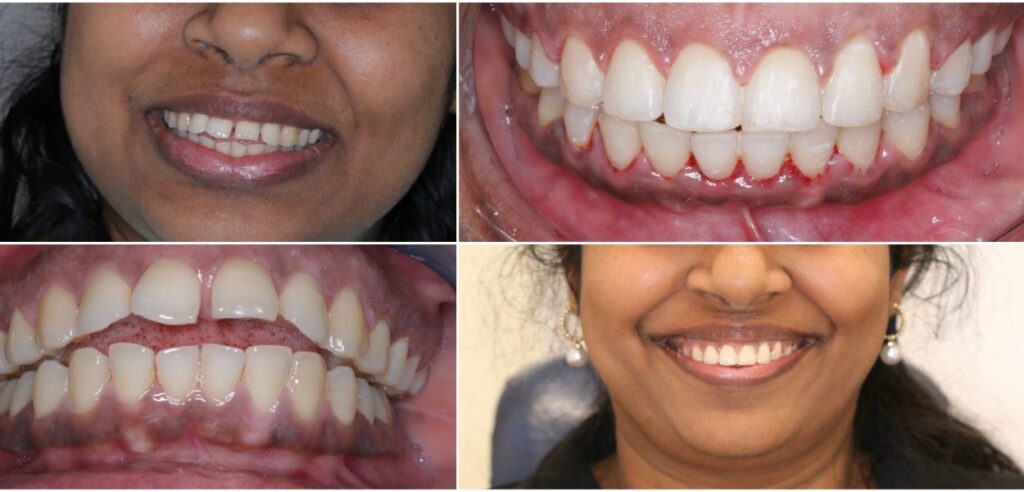 Smile Gallery | Six Month Smile - Ardent Smile clinic