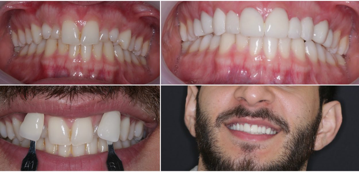 Smile Gallery | Veneers - Ardent Smile clinic