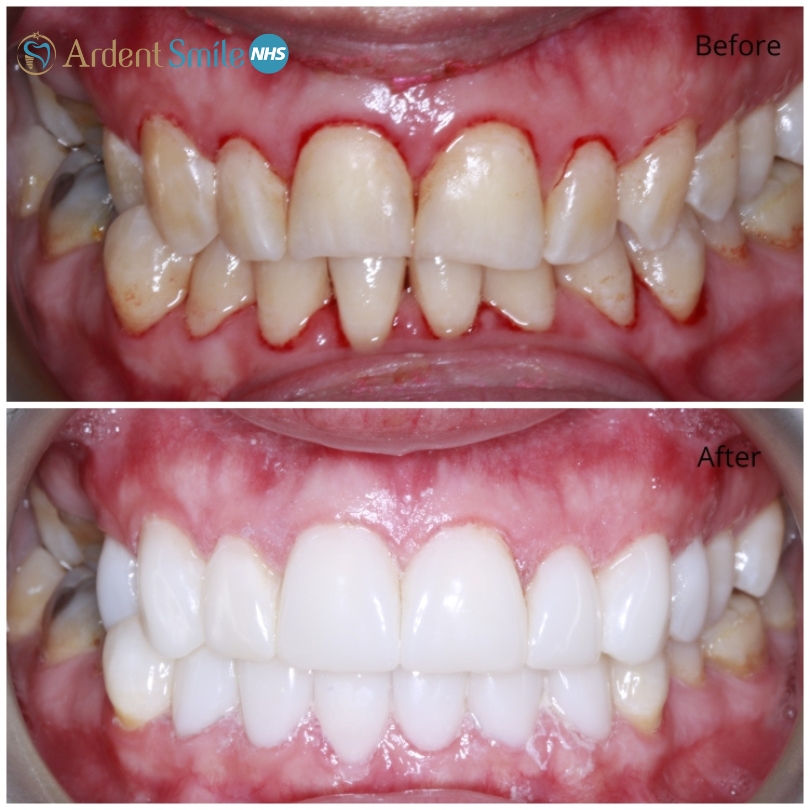 Smile Gallery | Composite Bonding - Ardent Smile