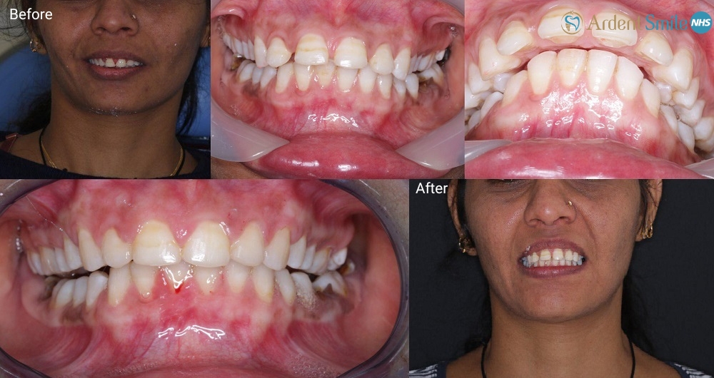 Smile Gallery | Smile Makeovers - Ardent Smile