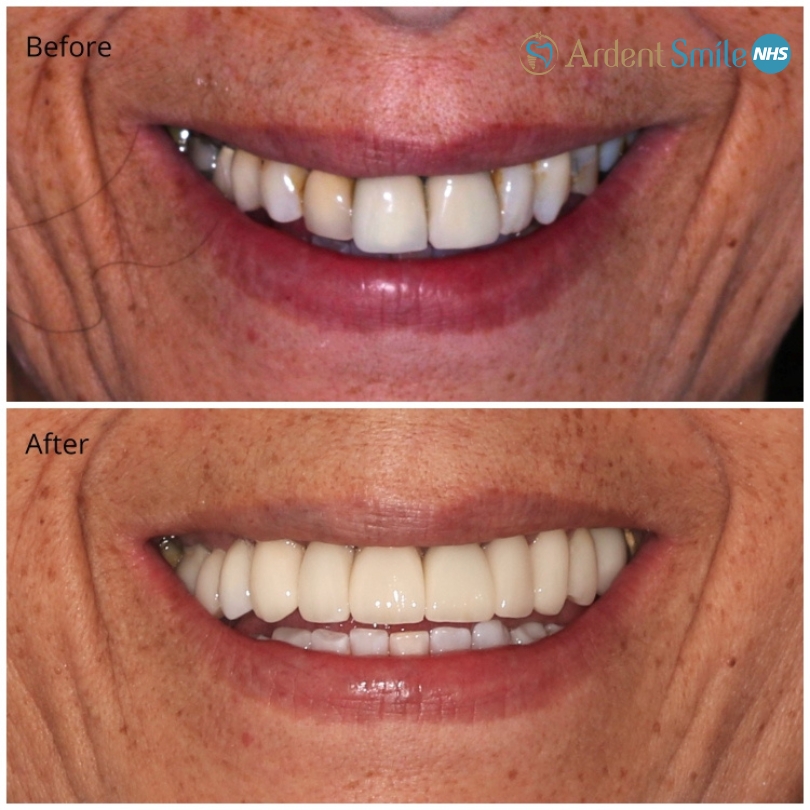Smile Gallery | Dental Crown - Ardent Smile