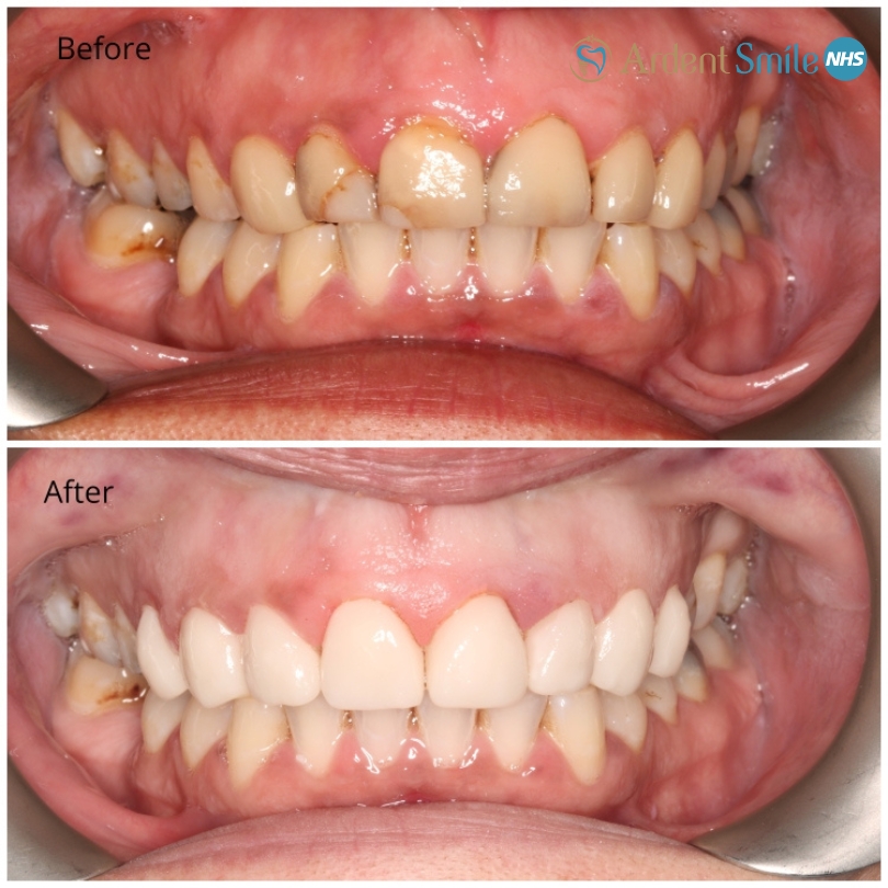 Smile Gallery | Smile Makeovers - Ardent Smile