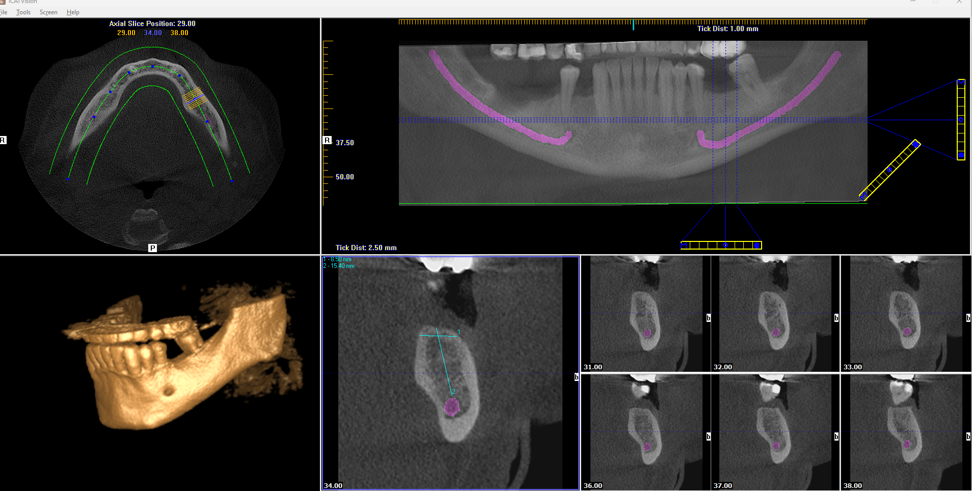 Why 3D Xray ( Cbct scan) is necessary before implant placement?