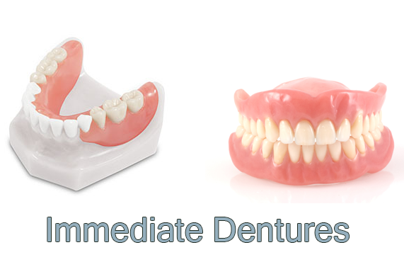 Immediate Dentures - Ardent Smile clinic