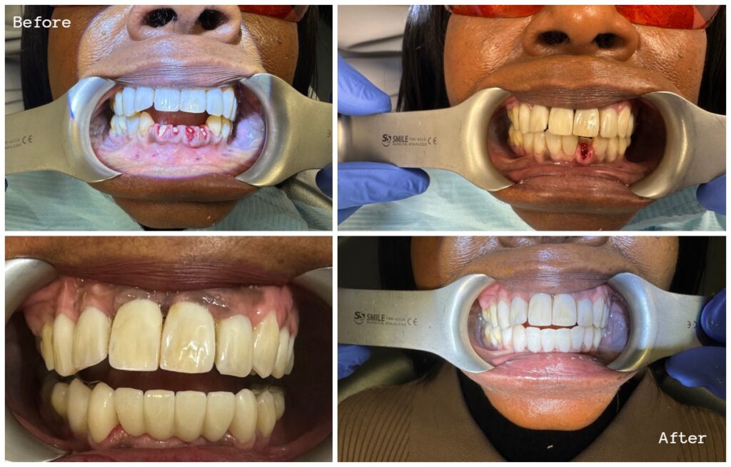 Dental Bridge - Smile Gallery - Ardent Smile